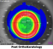 Marino Eye Care - Optometry In Miami, FL USA :: Orthokeratology or ...